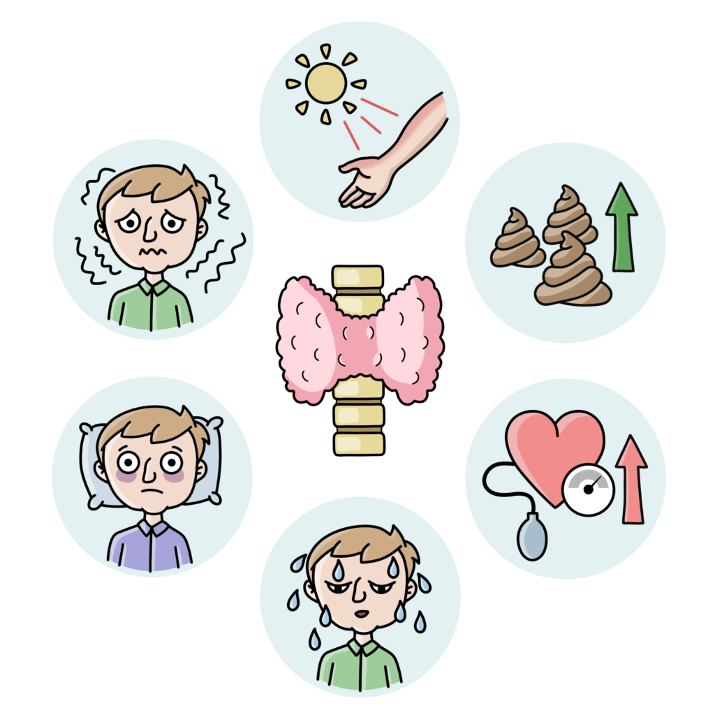 Hipertiroidismo - Endocrinólogo Tijuana